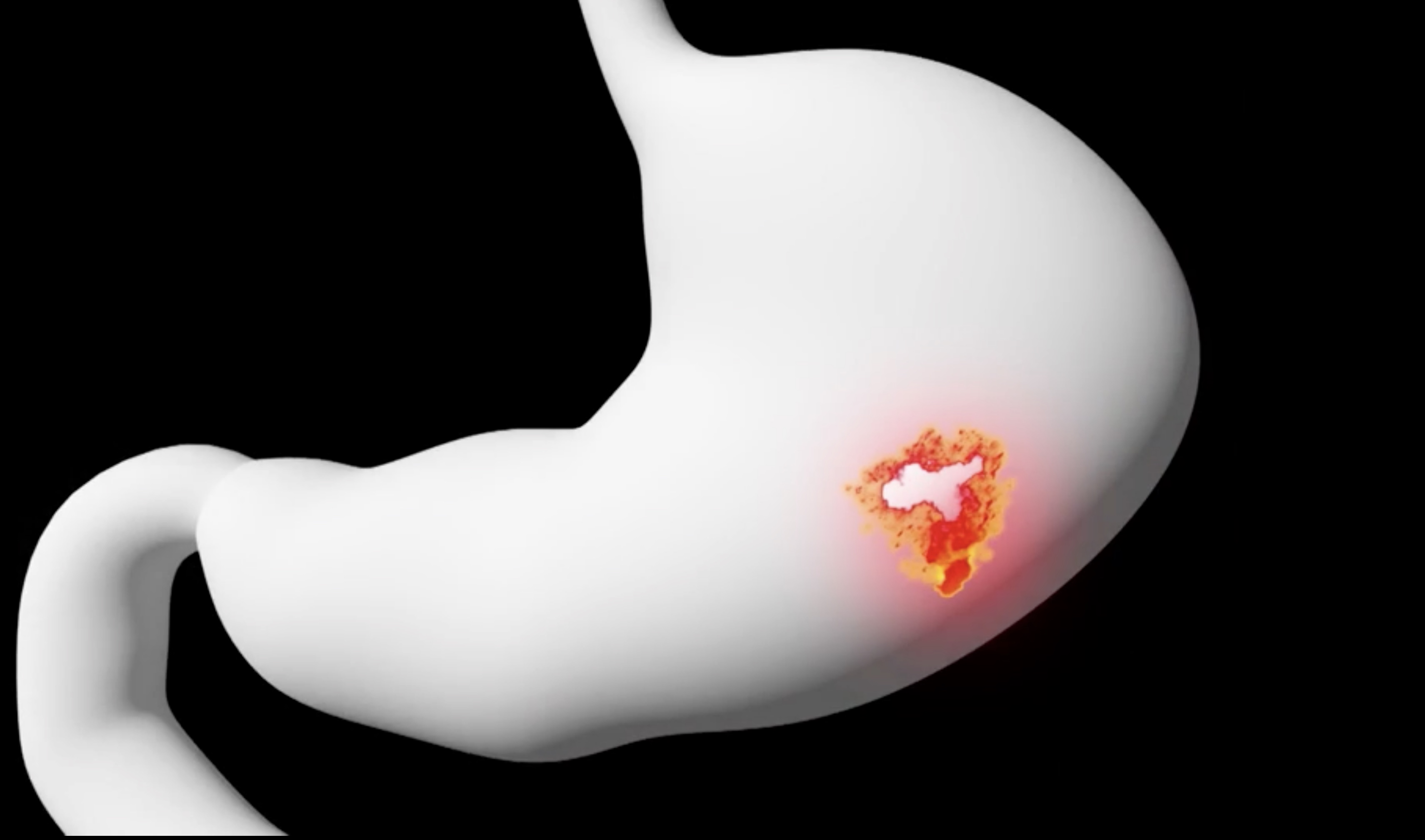 ¿Qué es una úlcera gástrica y por qué aparece? | Canal Extremadura